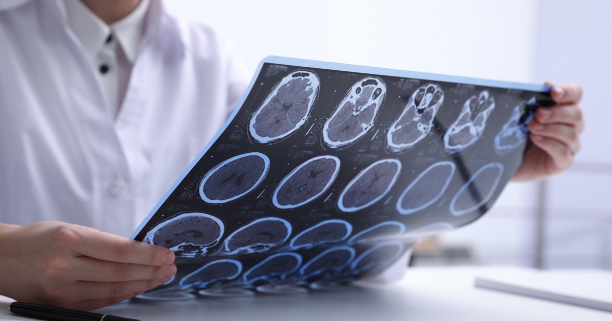 MS Scales | Brigham Multiple Sclerosis Center